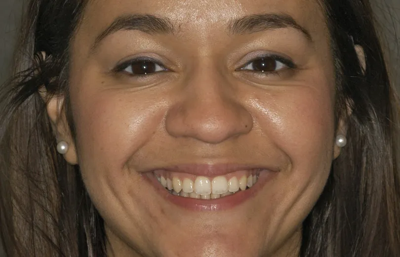Dental Smile Gallery Manhattan | Before & After Dental Photos Manhattan ...
